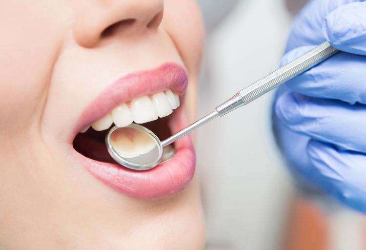 Rellenos dentales: conoce sus beneficios - Clínica Kranion
