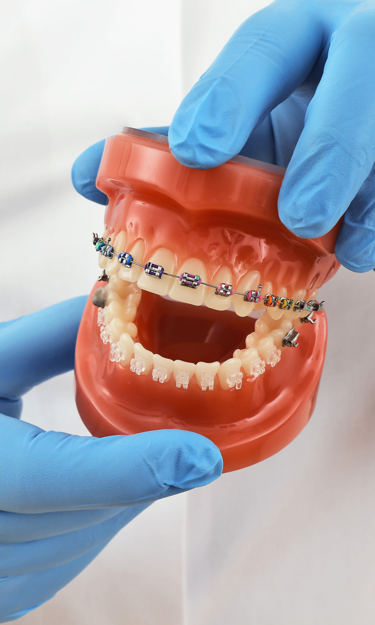 ¿Qué alimentos comer con brackets? - Clínica Kranion