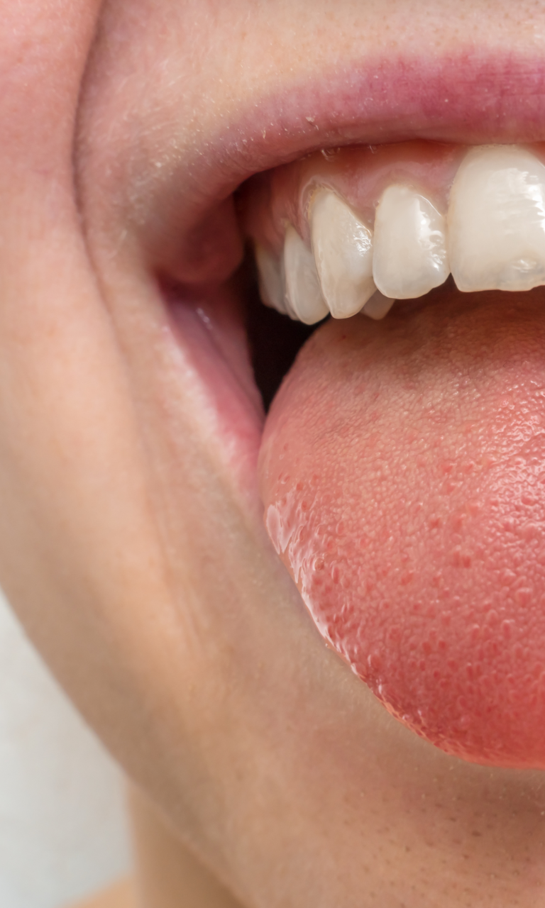 Lengua: enfermedades y lesiones frecuentes - Clínica Kranion