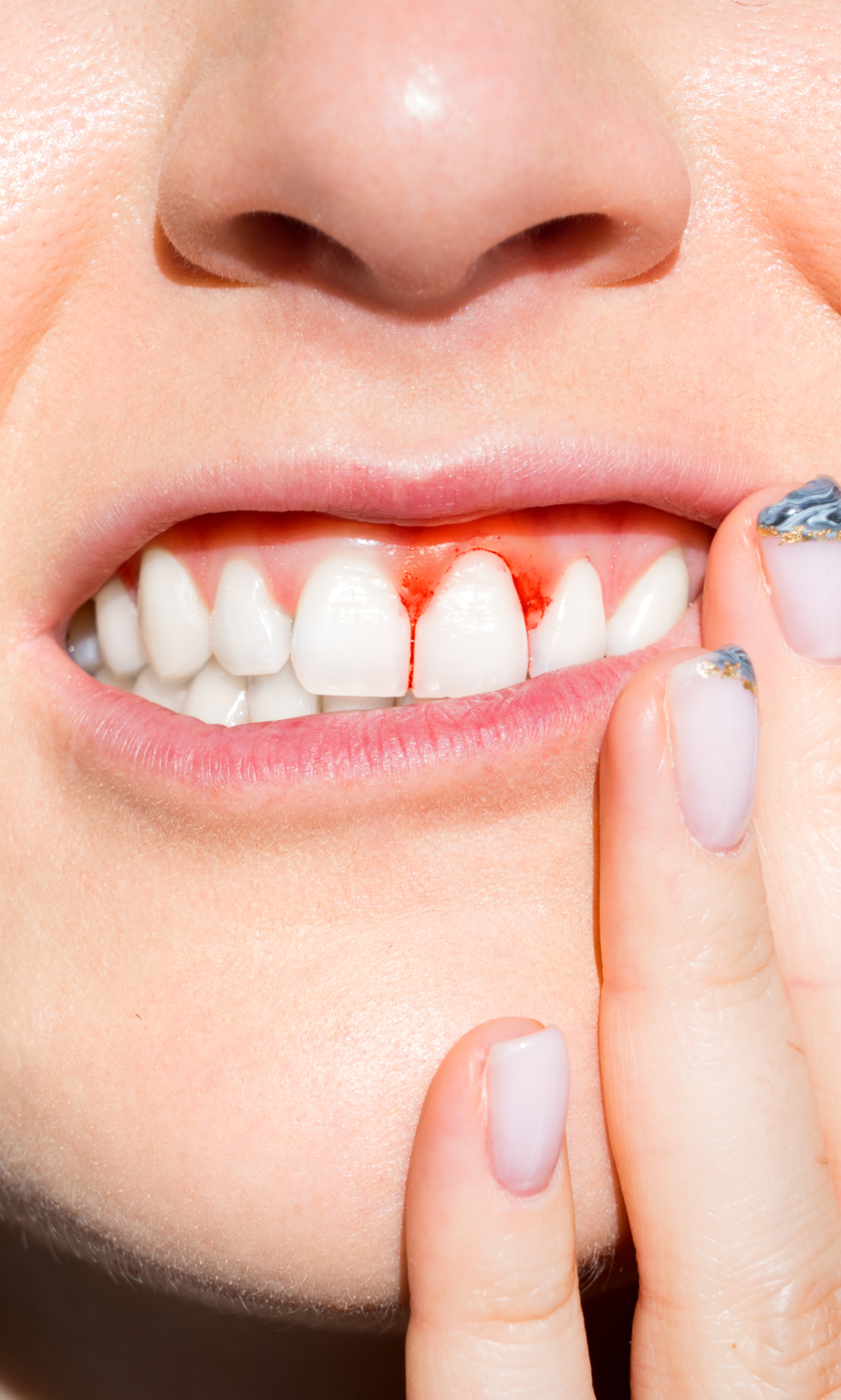 Las enfermedades periodontales más comunes - Clínica Kranion