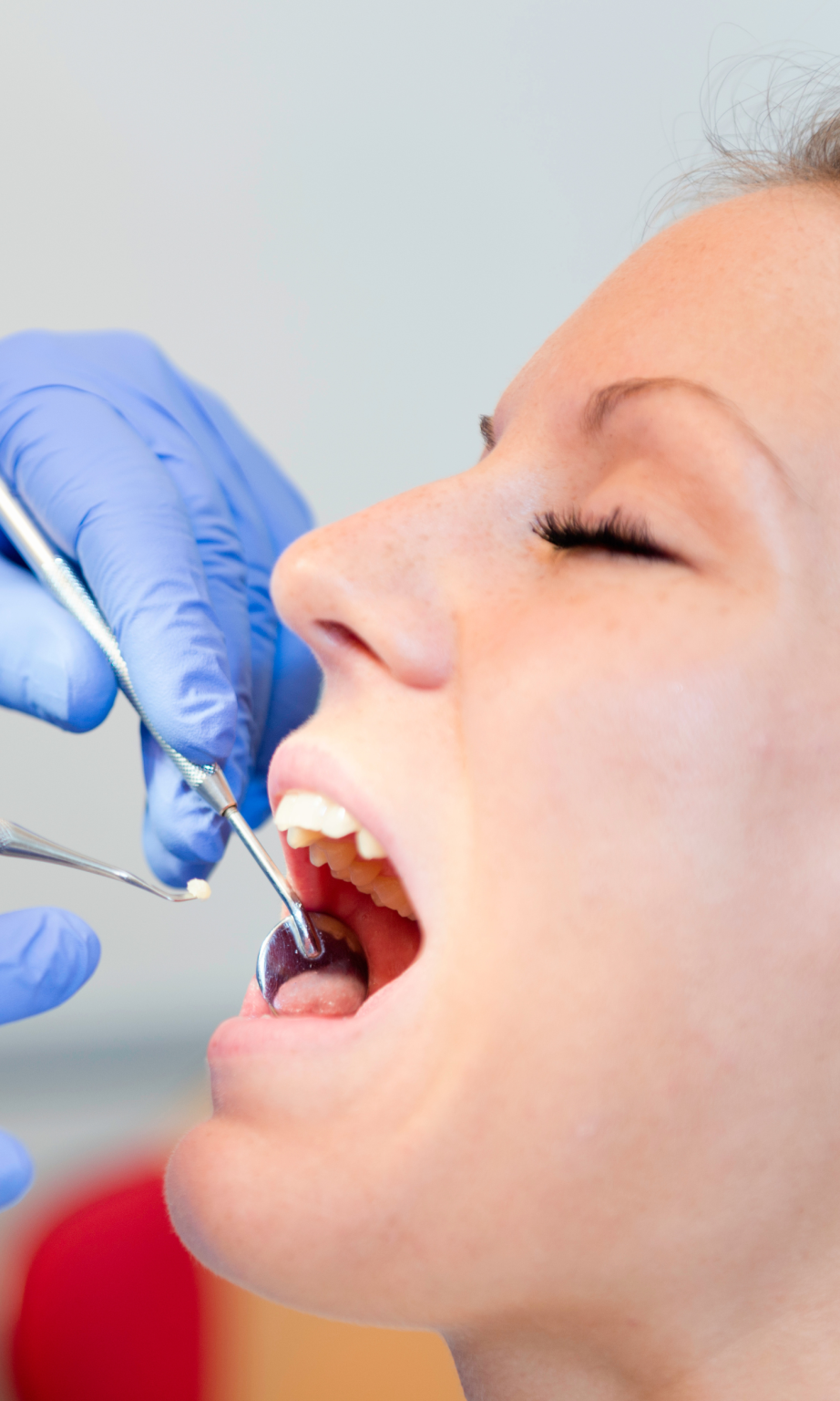 Rellenos dentales: conoce sus beneficios - Clínica Kranion