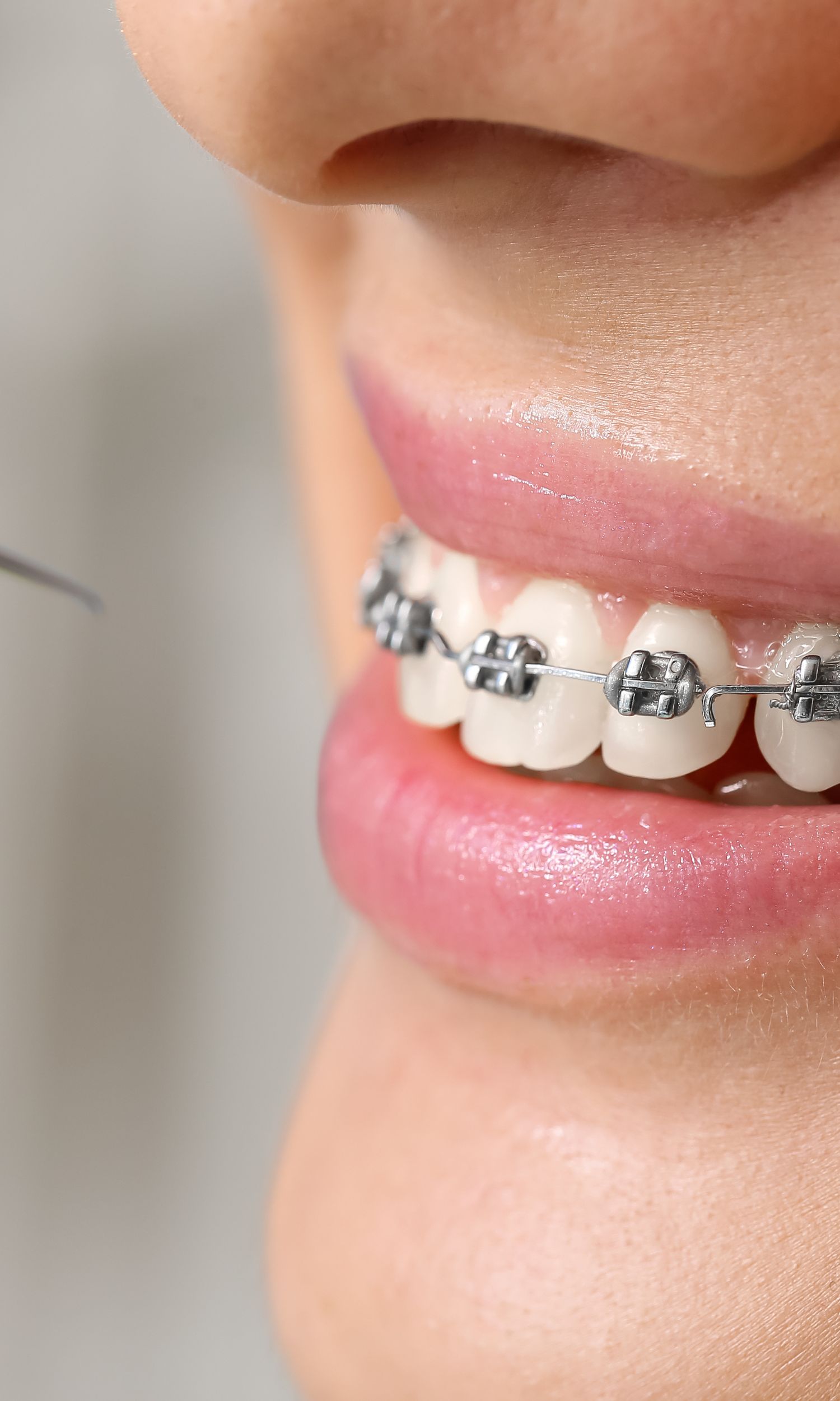 Ortodoncia y problemas de mordida - Clínica Kranion