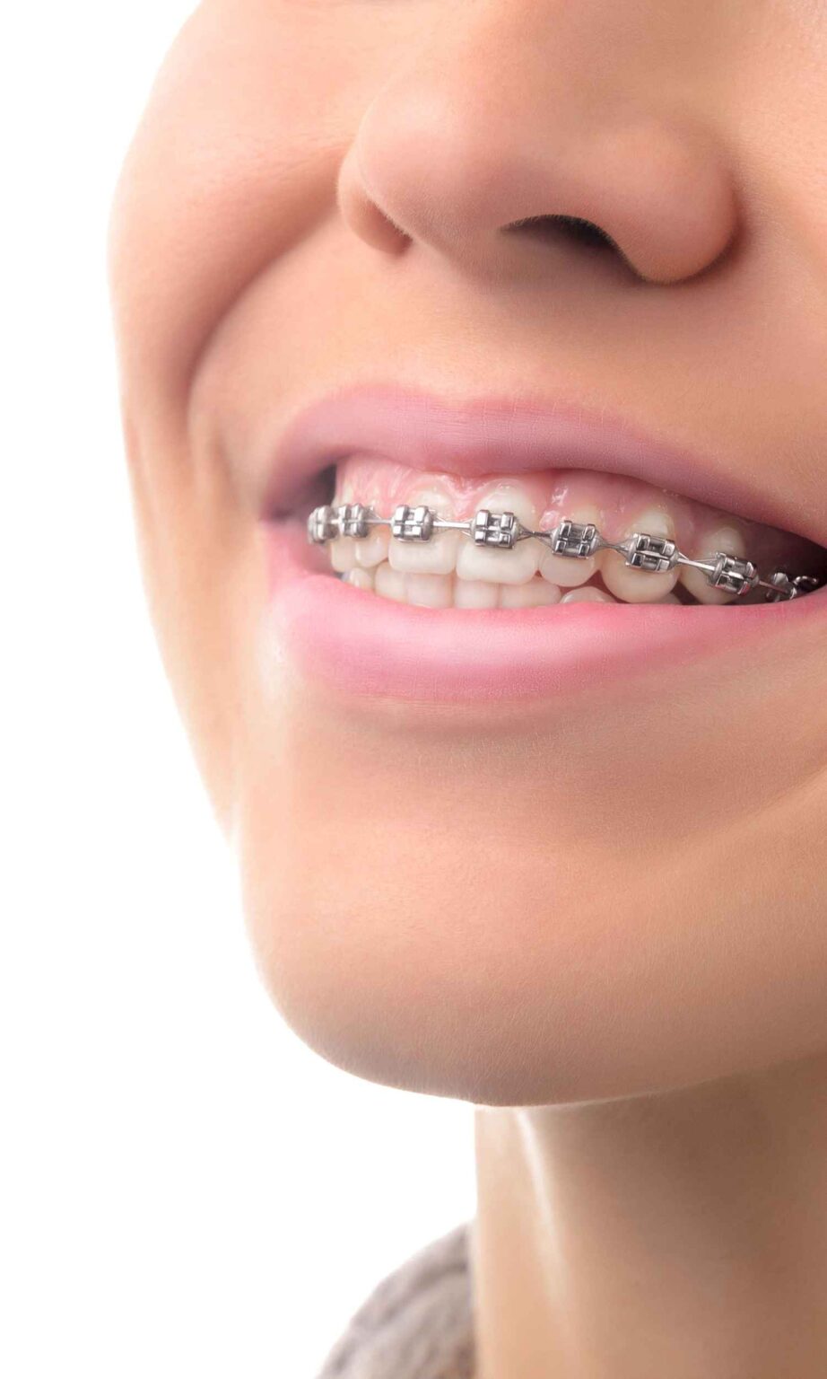 La verdad sobre los «brackets invisibles» - Clínica Kranion