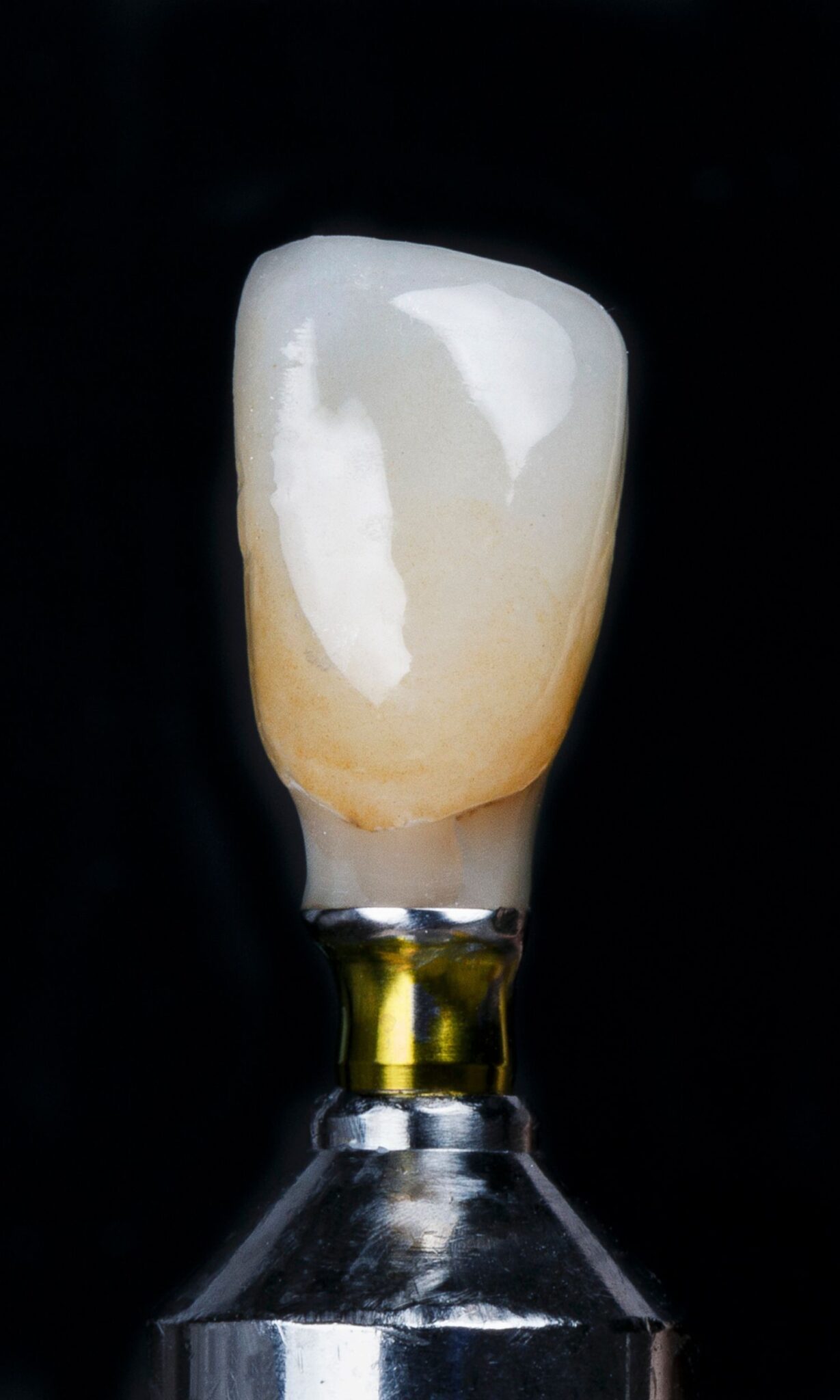 Coronas dentales: todo lo que debes saber - Clínica Kranion