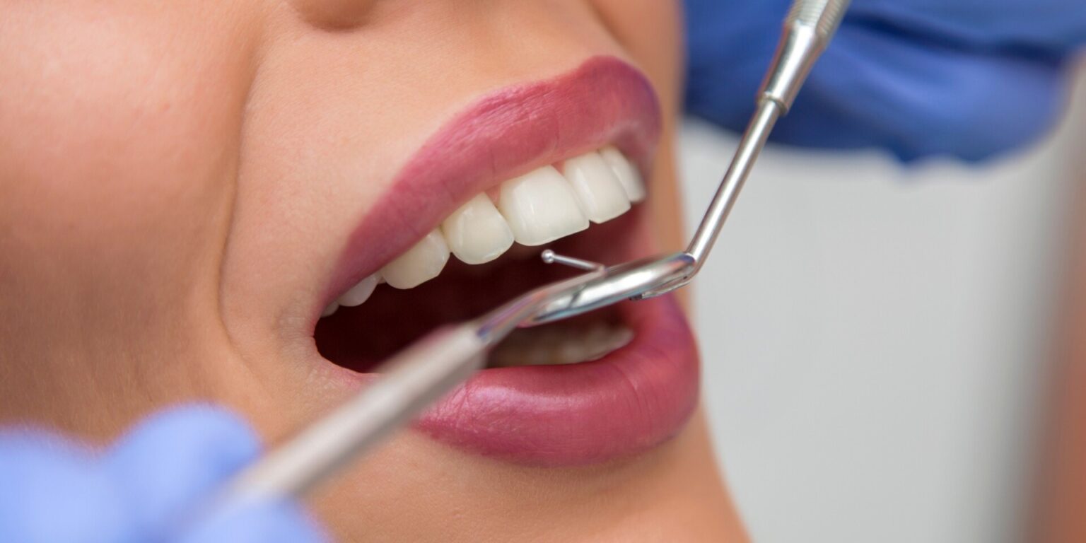 Rellenos dentales: conoce sus beneficios - Clínica Kranion