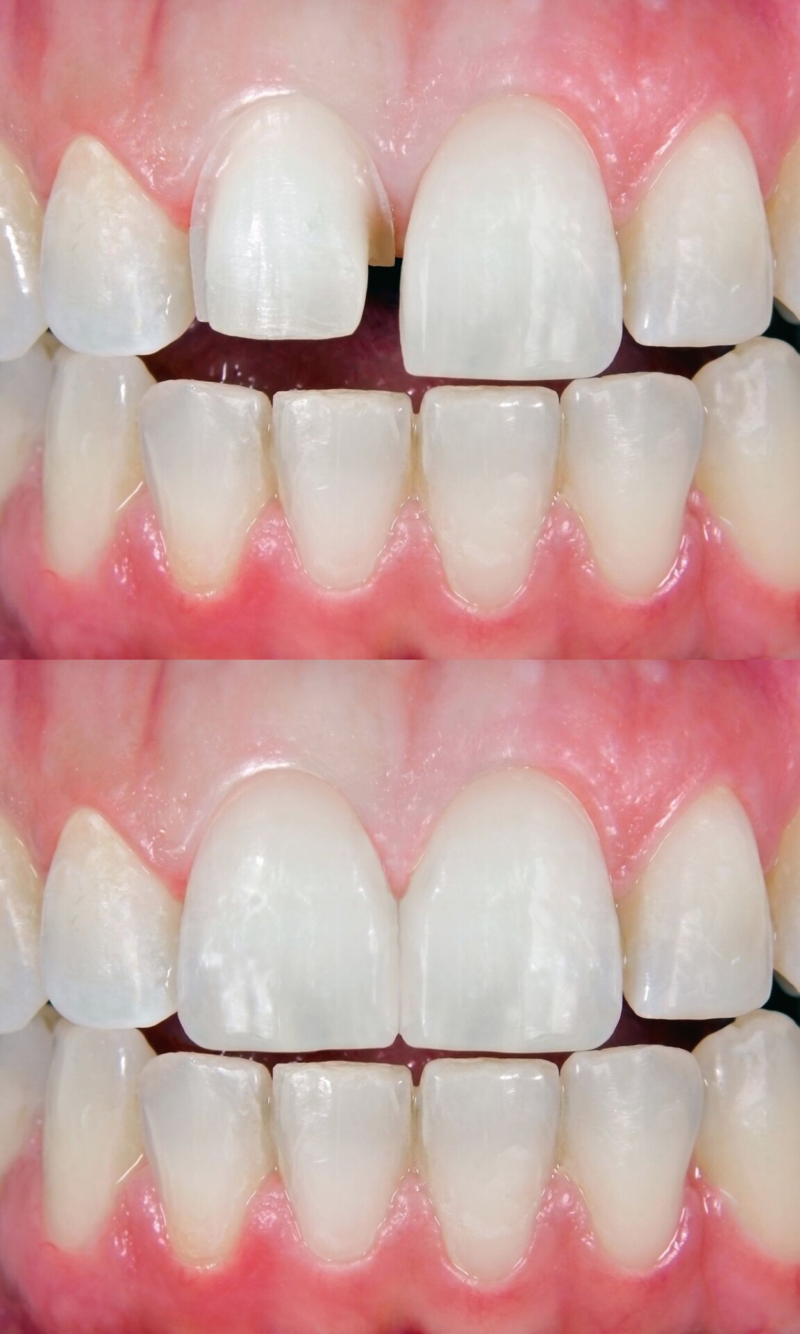 ¿Las carillas dentales son permanentes? - Clínica Kranion