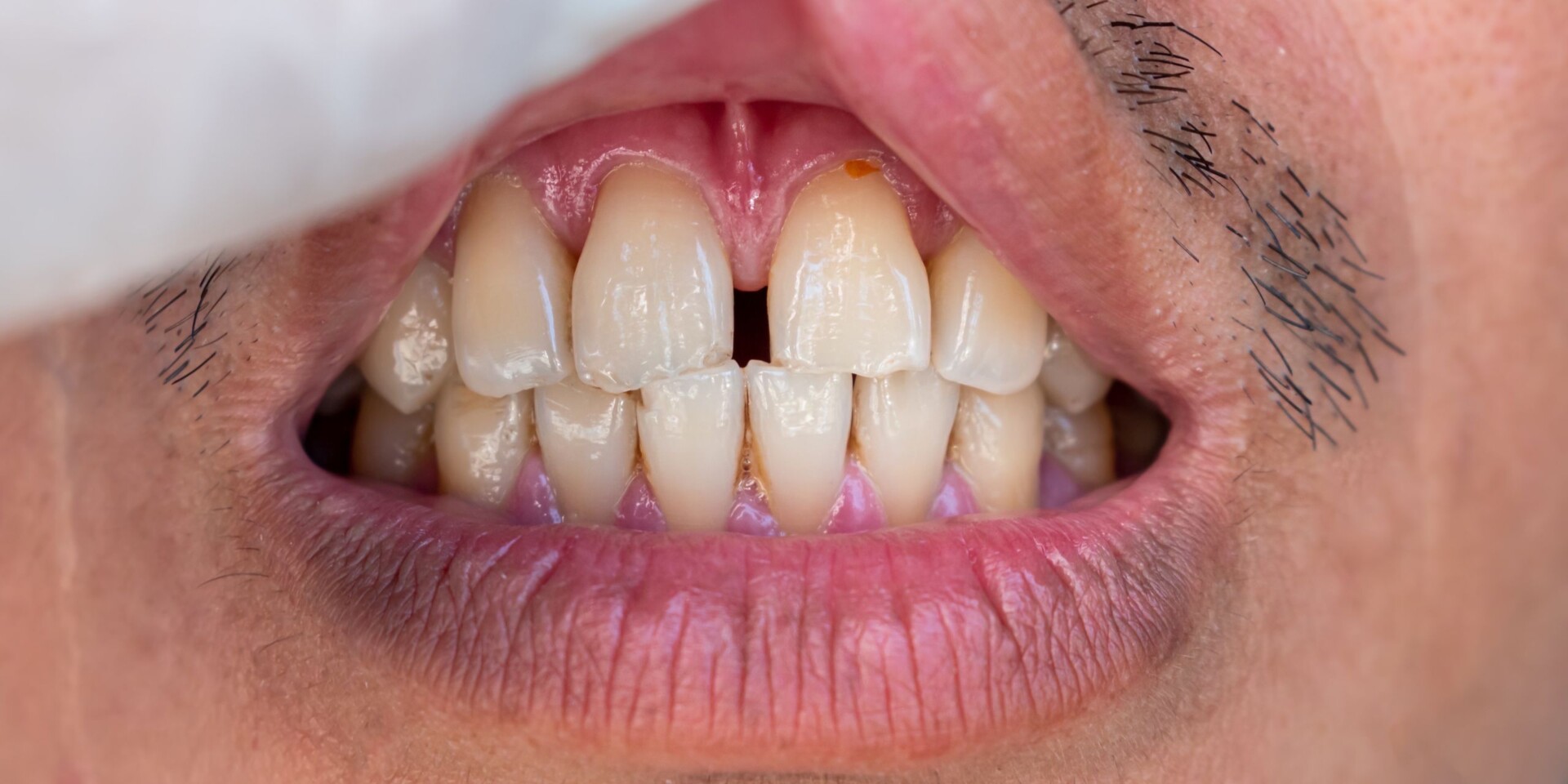 Diastema: ¿Qué es y cómo se puede tratar? - Clínica Kranion