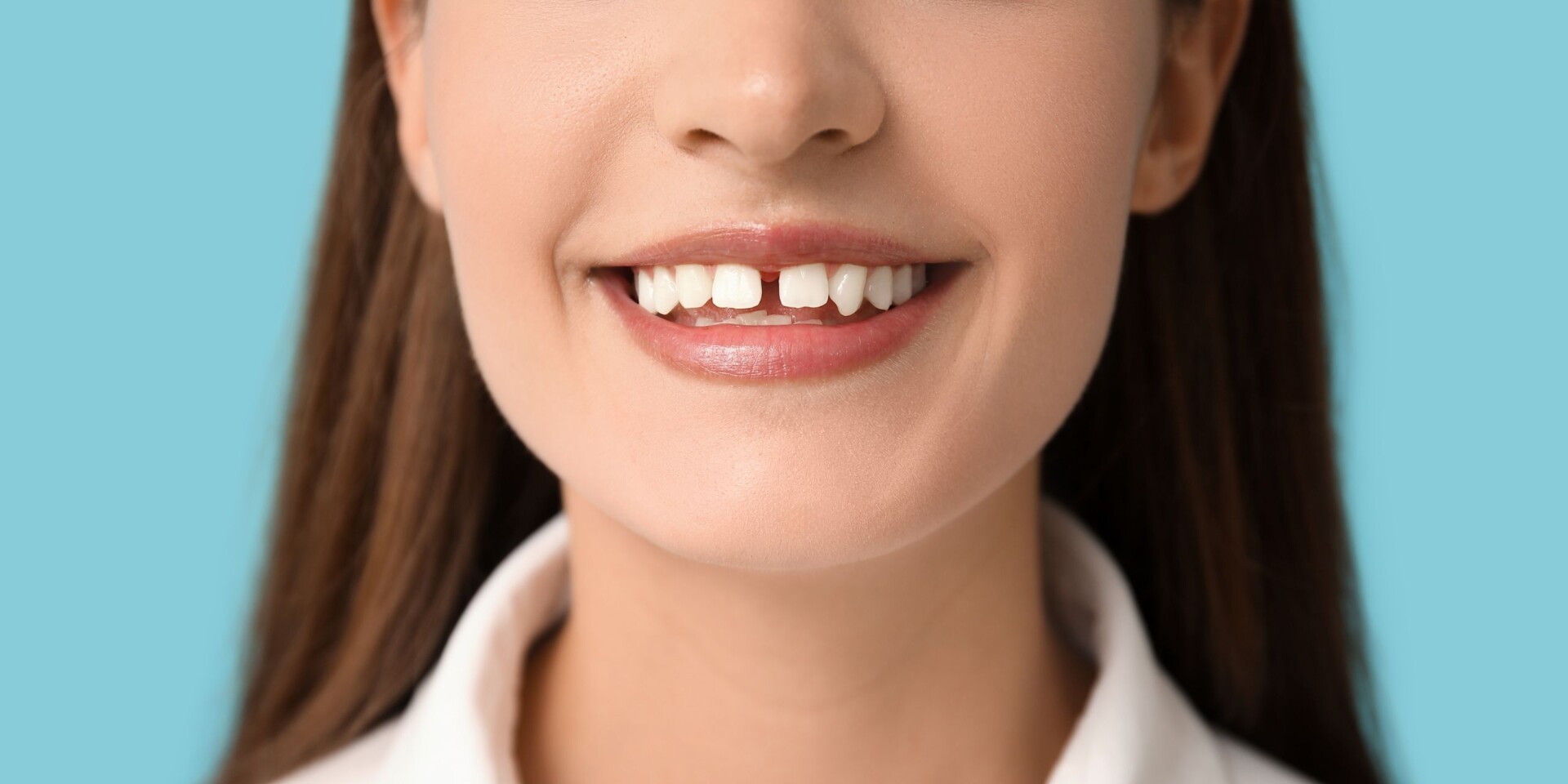 Diastema: ¿Qué es y cómo se puede tratar? - Clínica Kranion