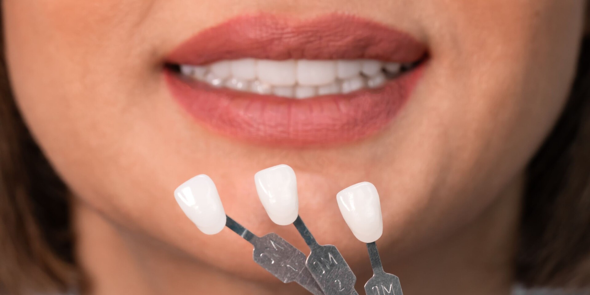 6 Datos sobre las Carillas Dentales - Clínica Kranion